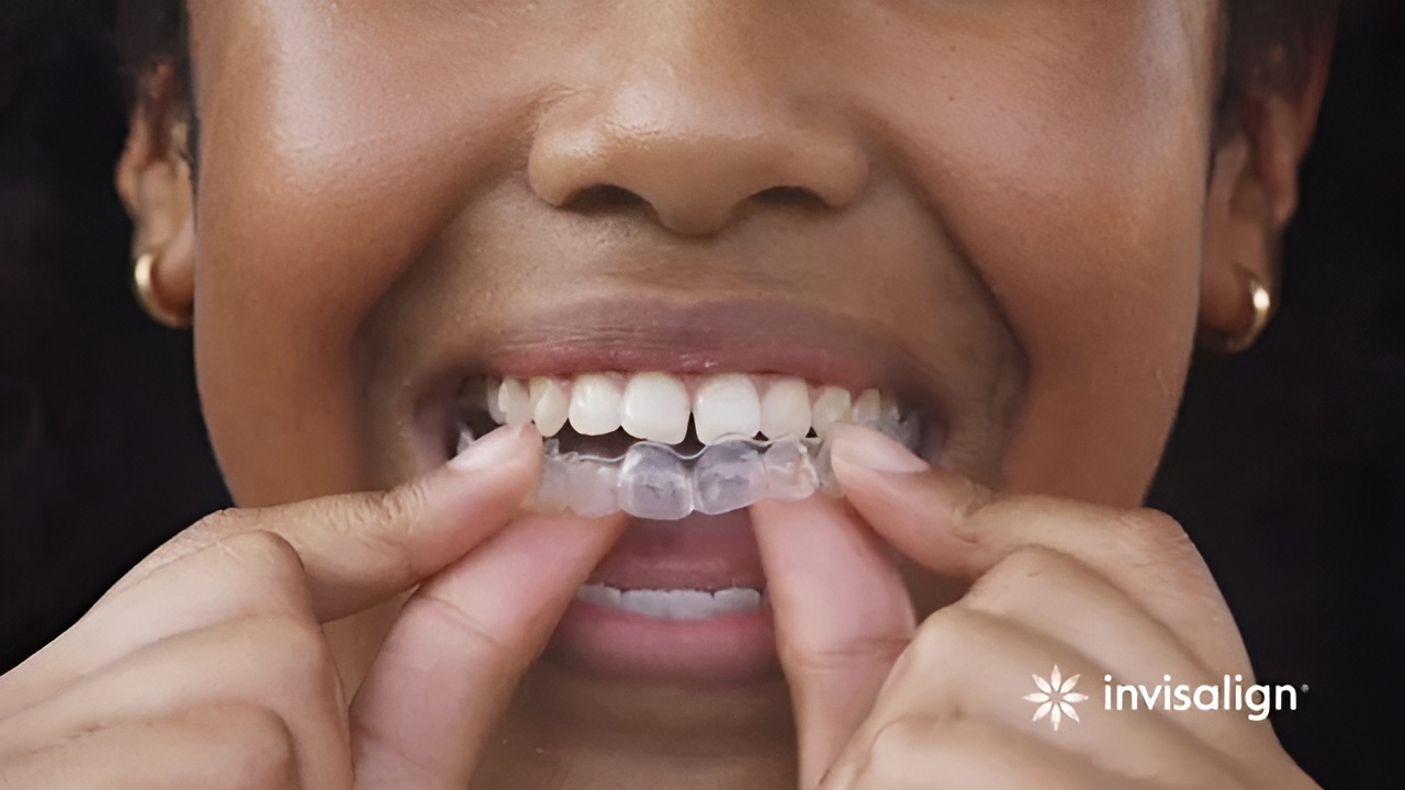 Invisalign Service in Nairobi | Emerald Dental Clinic Nairobi