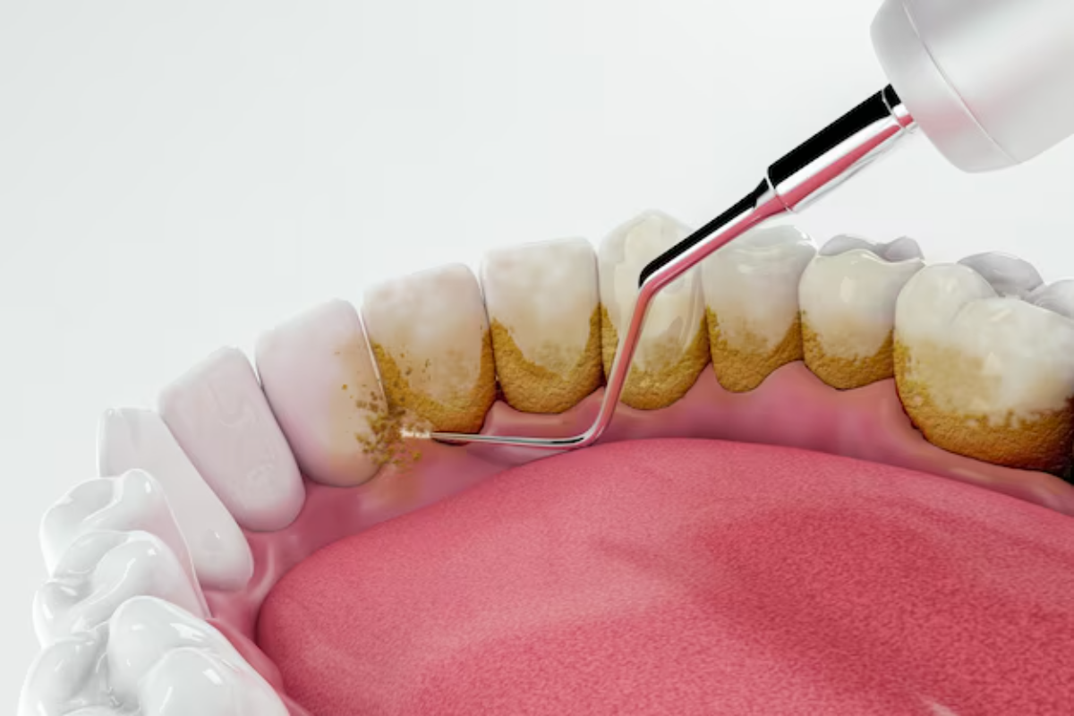 Dental Cleaning Service Nairobi | Quality Dental Braces